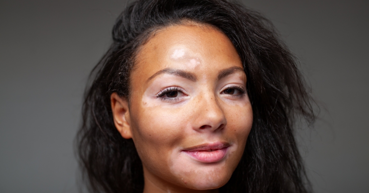 National Skin Centre launches vitiligo data collection in Southeast ...